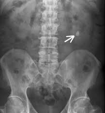 A stone in your kidney but no pain…what to do? – Northeast Georgia ...