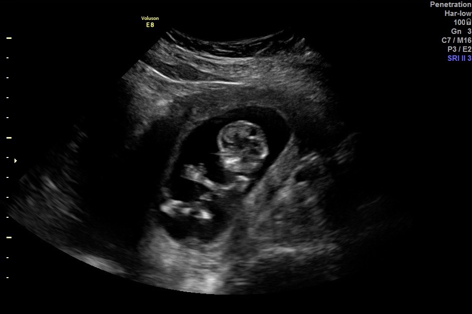 What is the verumontanum and why is it important during GreenLight ...